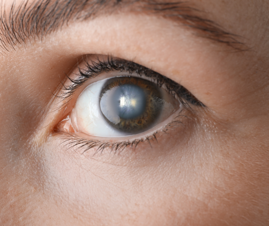 Exploring New Frontiers in Cataract Treatment and Research - Ora LLC